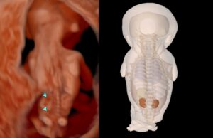 11 Weeks Gestation - 3D Human Development
