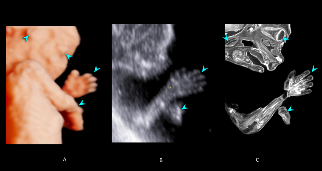 13 Weeks Gestation - 3D Human Development
