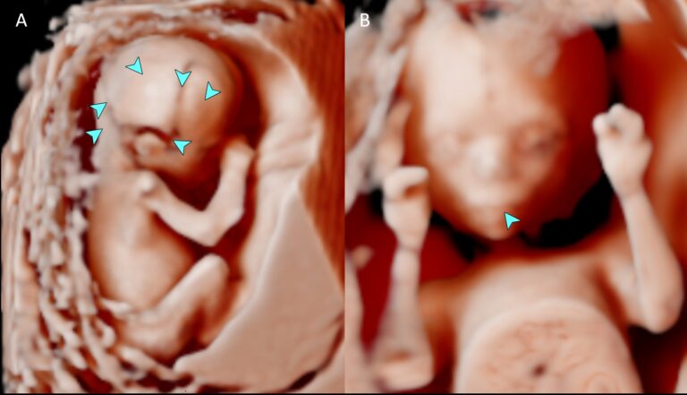 15 Weeks Gestation - 3D Human Development