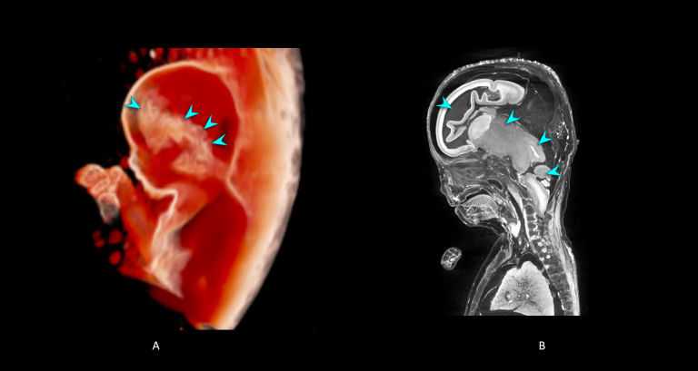 16 Weeks Gestation - 3D Human Development