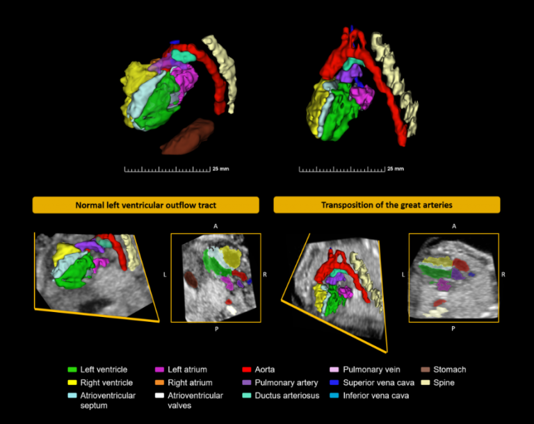 Unlocking the shape of the fetal heart - 3D Human Development